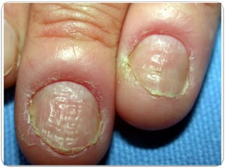 Candidiasis.pptx Azizullah Aziz Abdali university | PPT