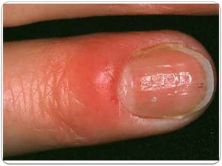 Candidiasis.pptx Azizullah Aziz Abdali university | PPT