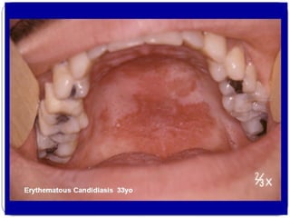 Candidiasis.pptx Azizullah Aziz Abdali university | PPT