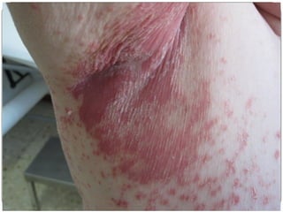 Candidiasis.pptx Azizullah Aziz Abdali university | PPT