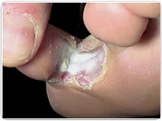 Candidiasis.pptx Azizullah Aziz Abdali university | PPT