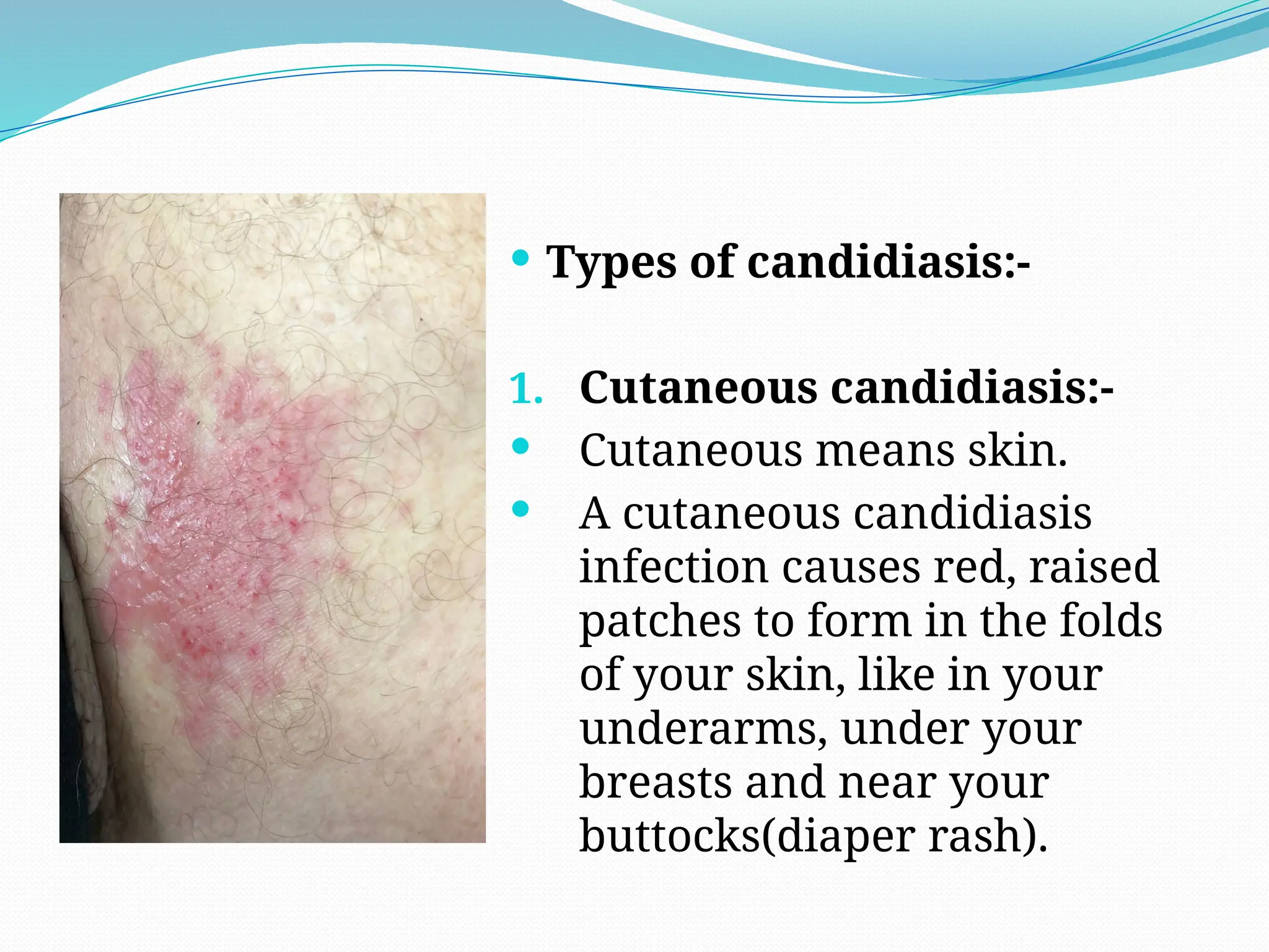 Candidiasis is fungal infection that.pptx