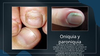 Candidiasis, enfermedades micoticas.pptx