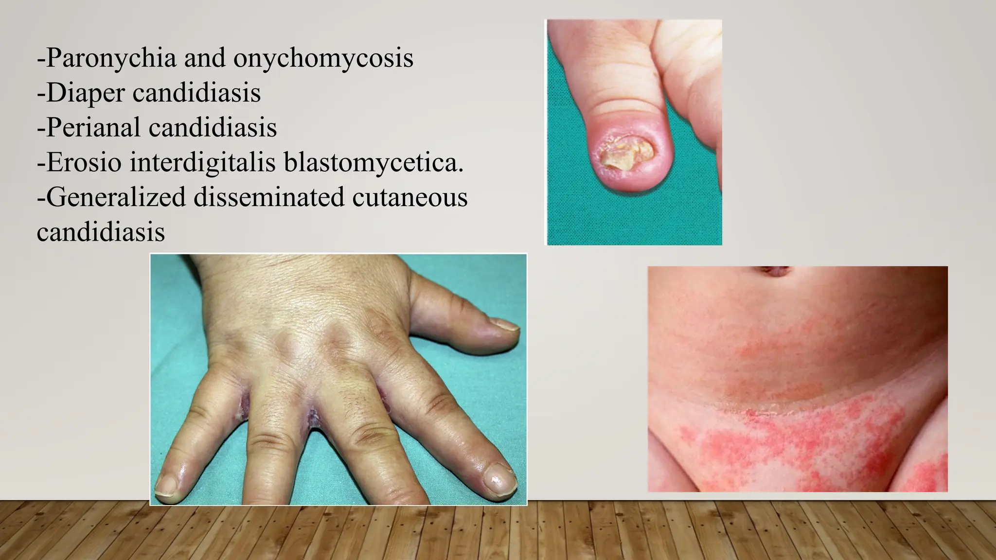 CANDIDIASIS: VIRULENCE FACTORS, PATHOGENESIS & LABORATORY DIAGNOSIS | PPTX