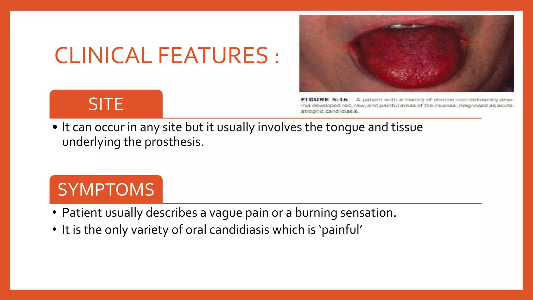 Candidiasis | PPTX