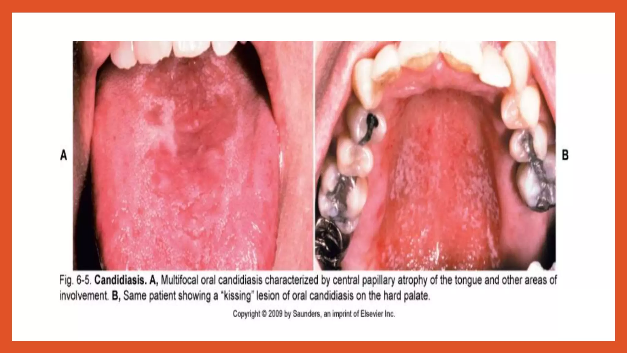 Candidiasis | PPTX