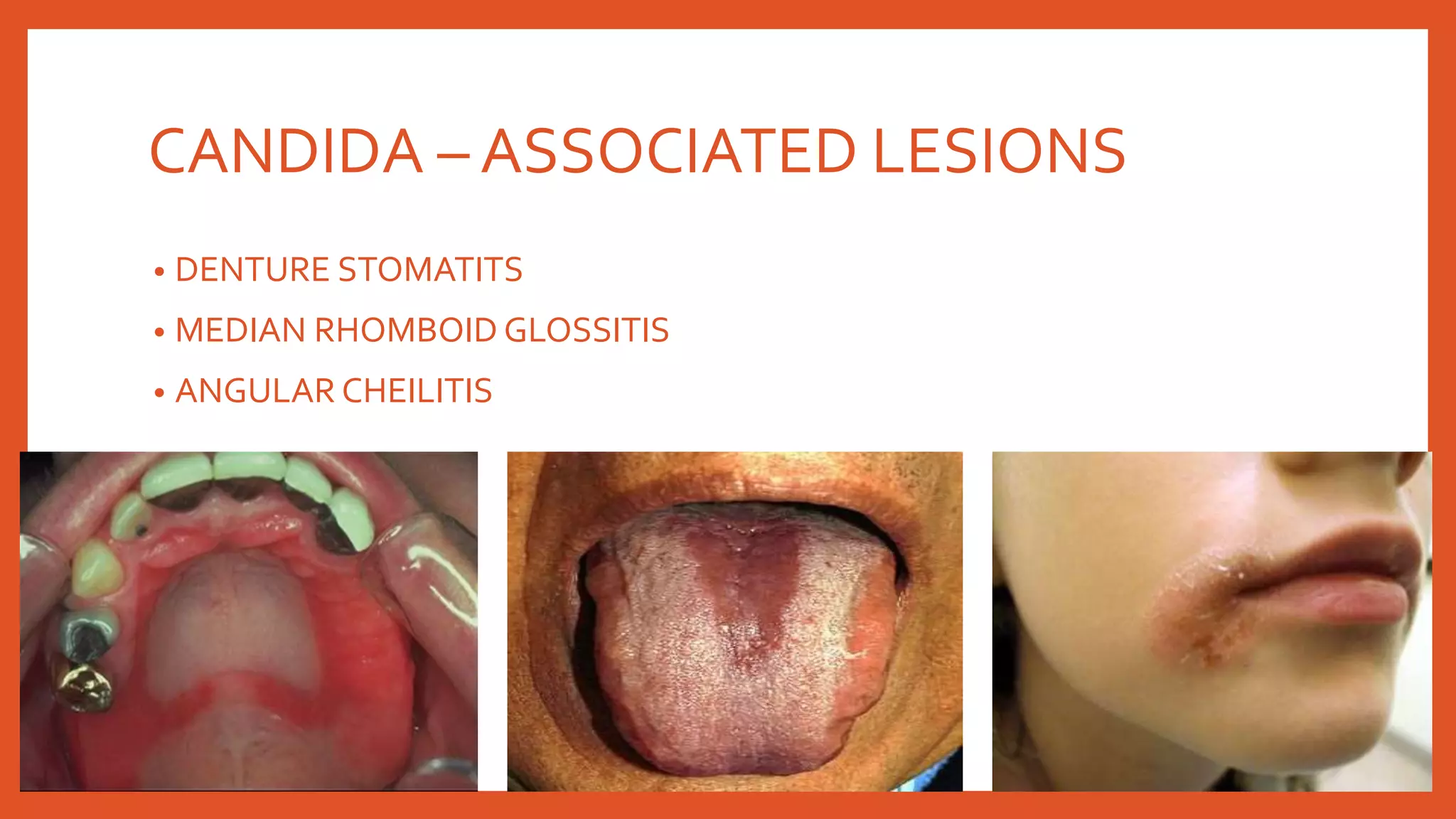 Candidiasis | PPTX | Dental Health | Diseases and Conditions