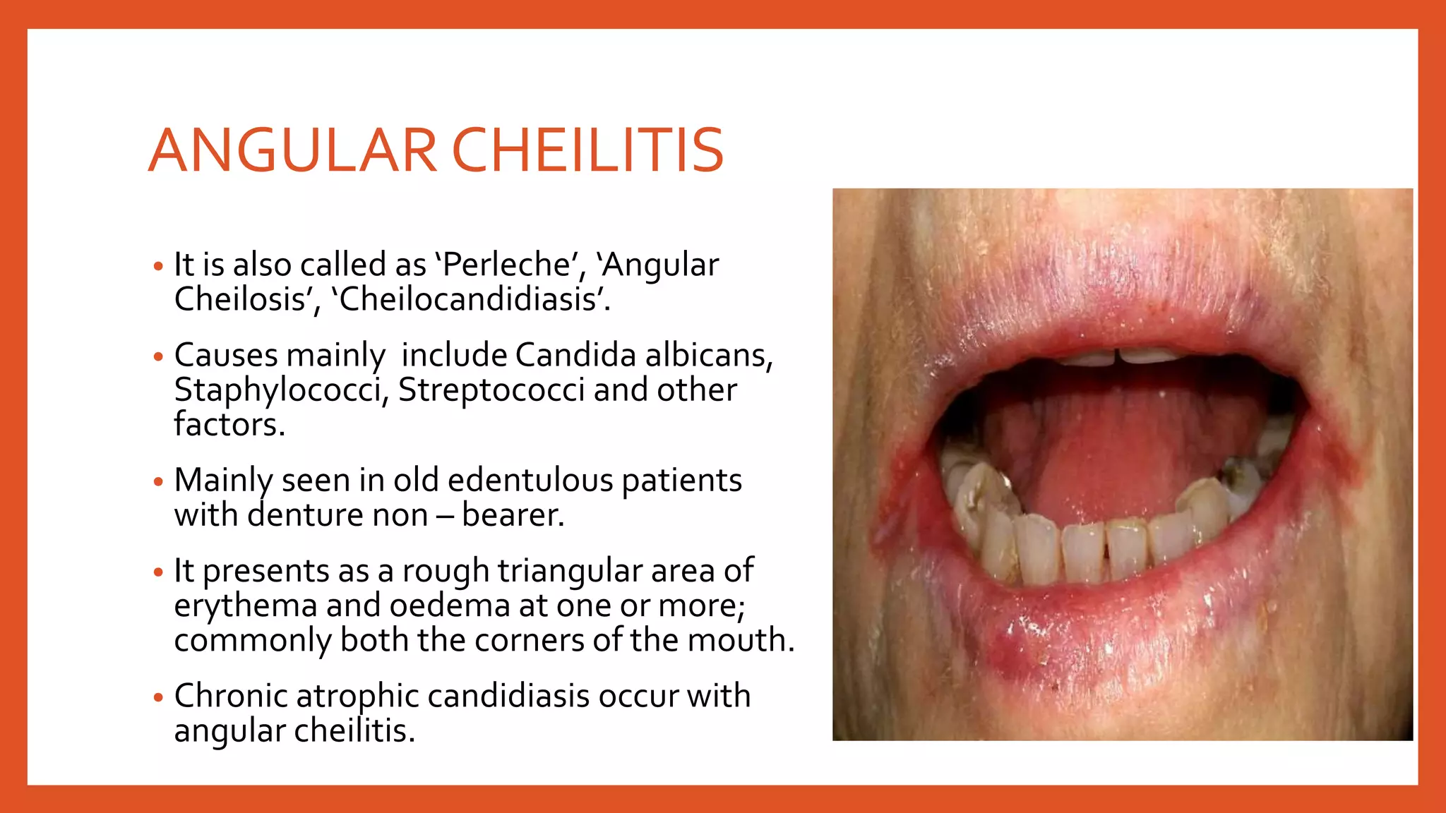 Candidiasis | PPTX