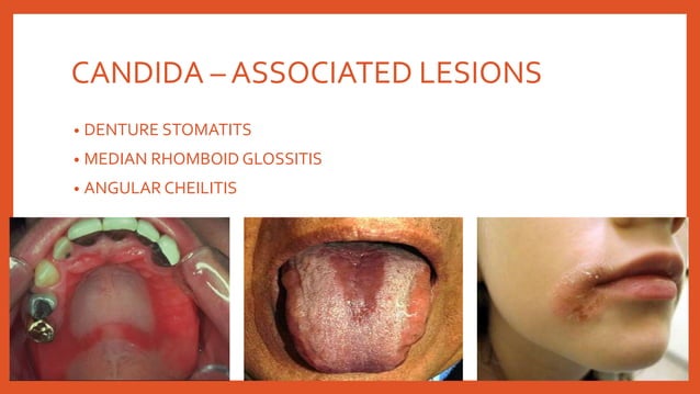 Candidiasis | PPTX | Dental Health | Diseases and Conditions