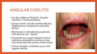 Chronic Atrophic Candidiasis