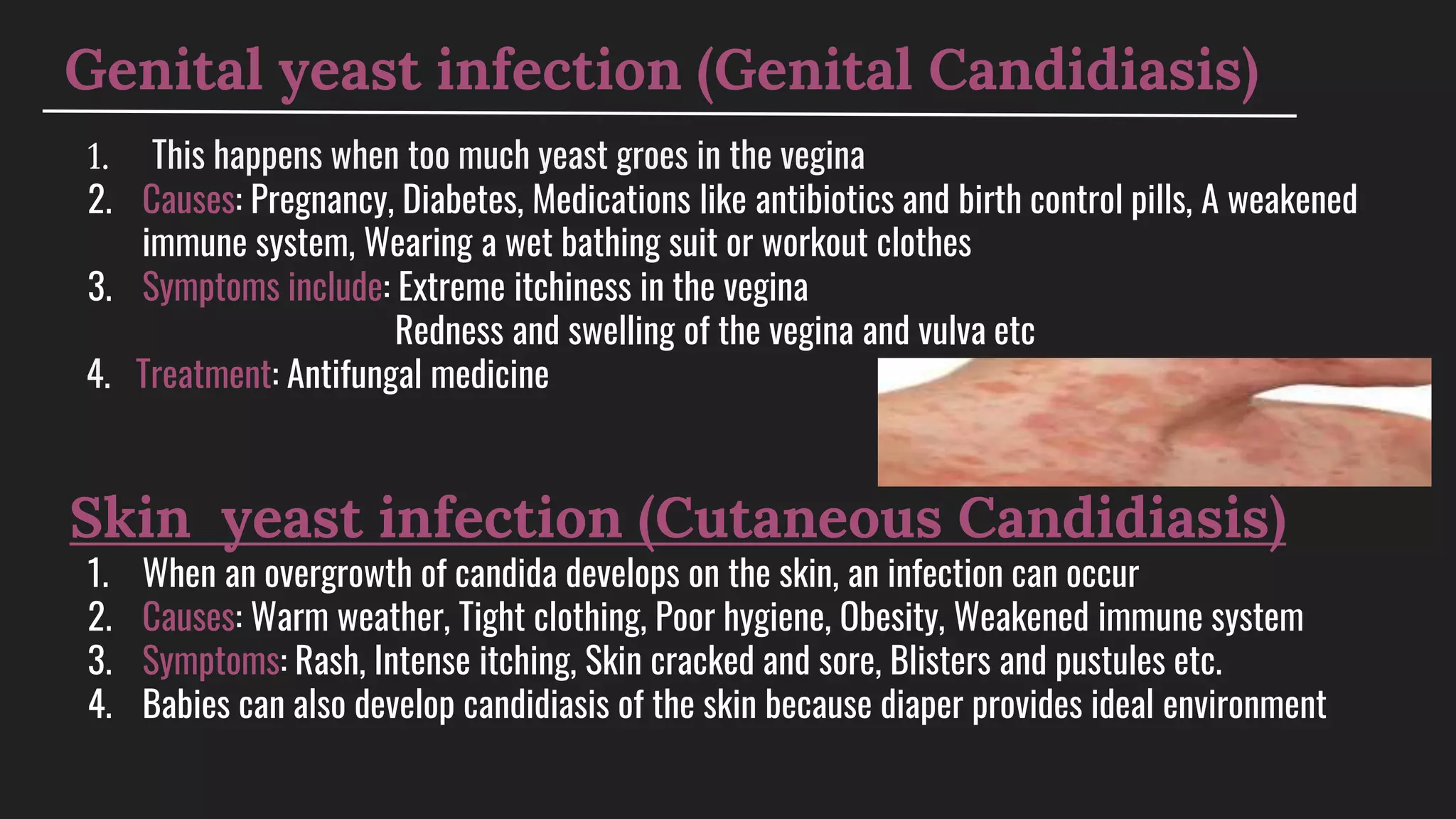 Candidiasis - Simran sakeena .pptx