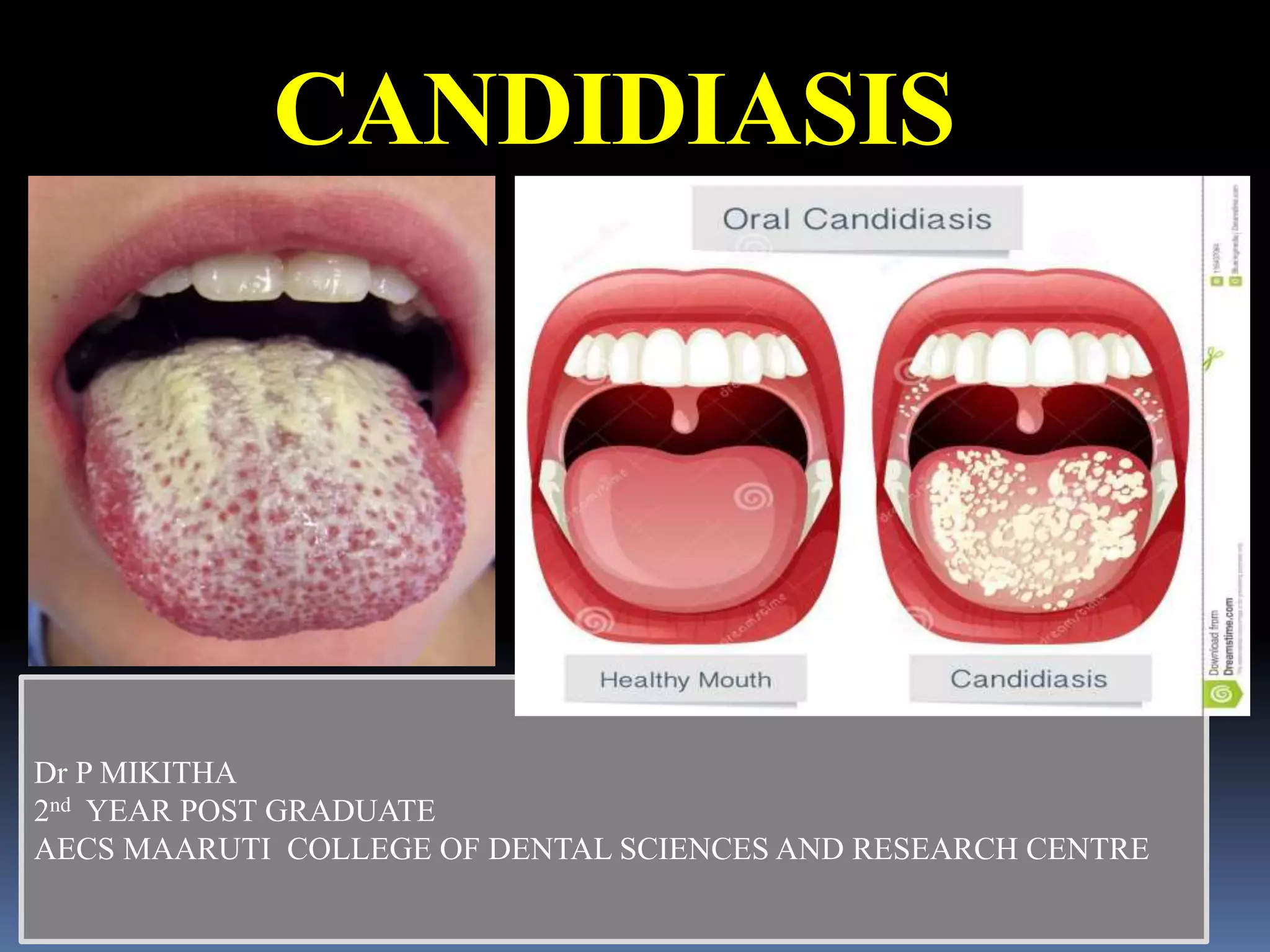 Candidiasis | PPT