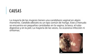 Definicion, tratamiento, signos y sintomas de candidiasis 2023.pptx