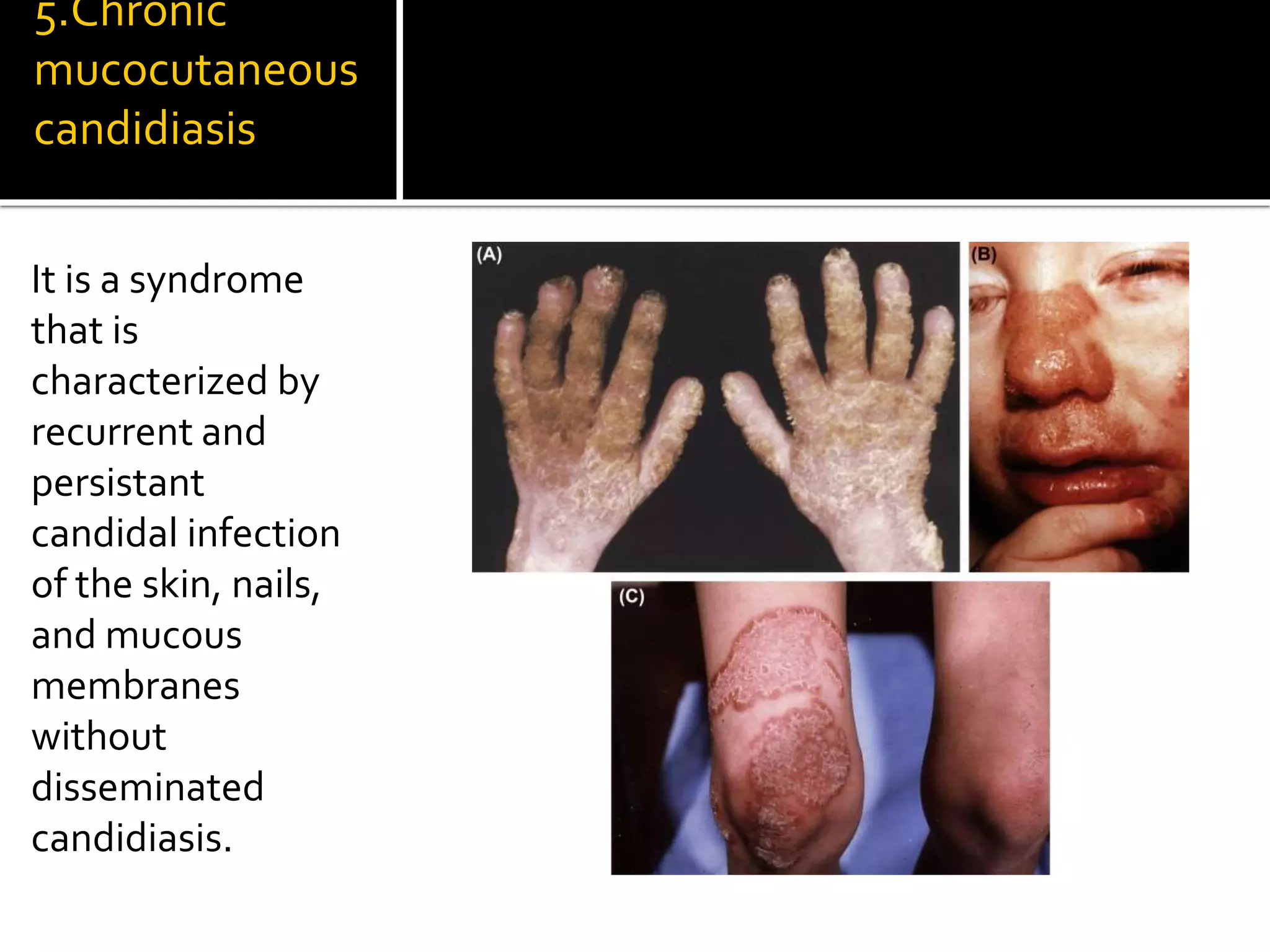 Candidiasis by dr.AJ