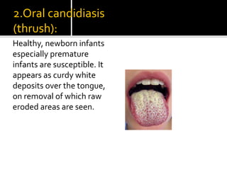 Candidiasis by dr.AJ