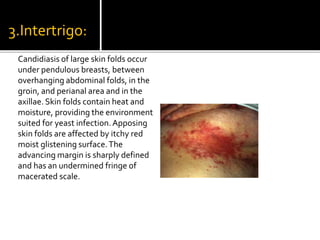 Candidiasis by dr.AJ