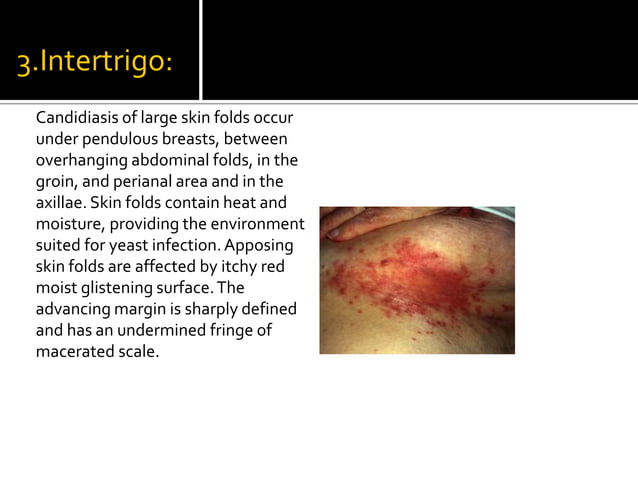 Candidiasis by dr.AJ