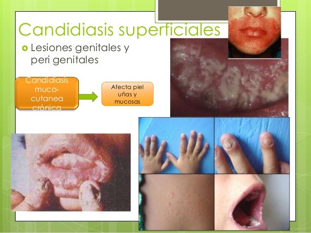 Candidiasis casi listo