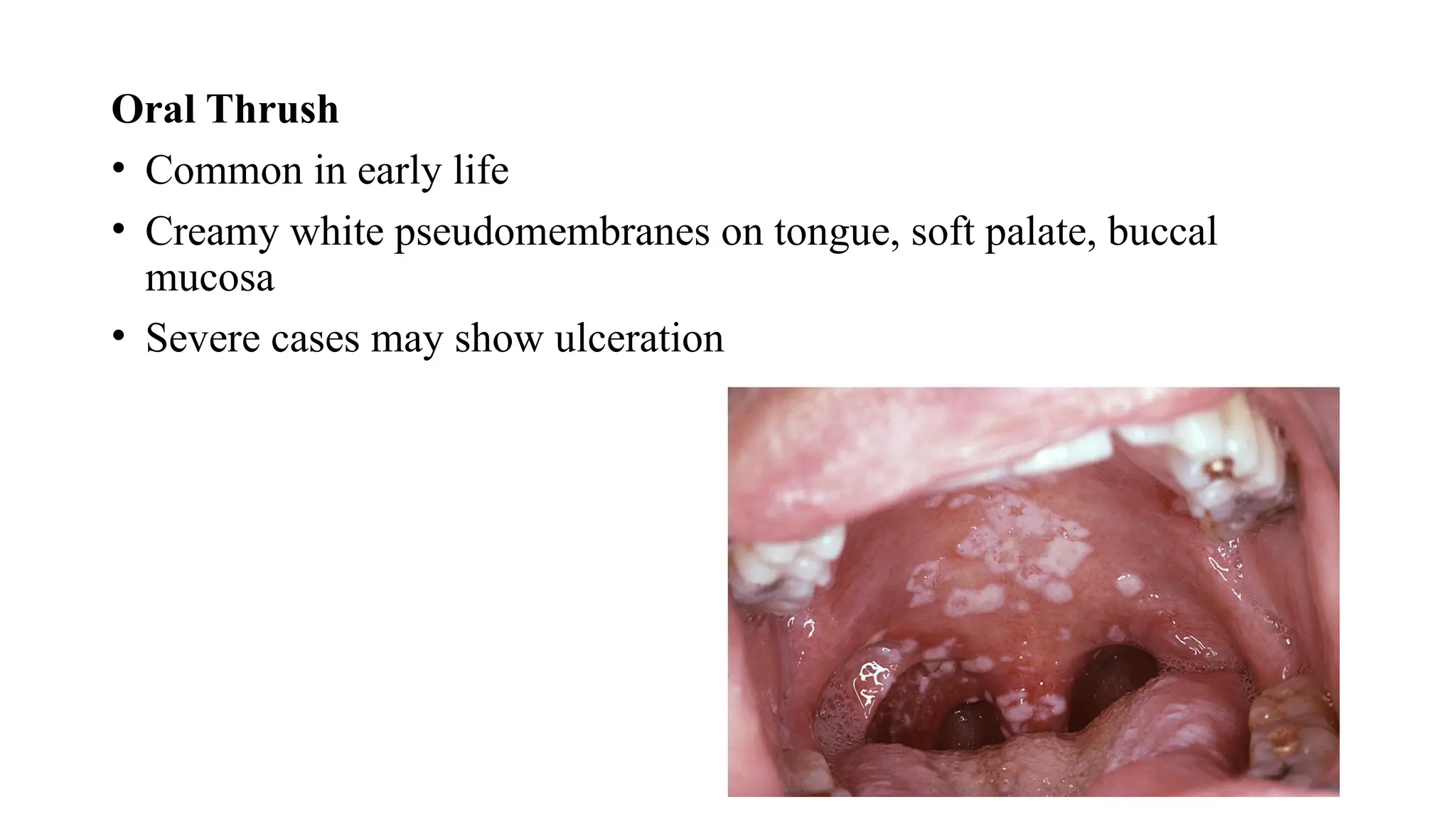 Candidiasis An overview Dr Rajesh Patil Sir.pptx