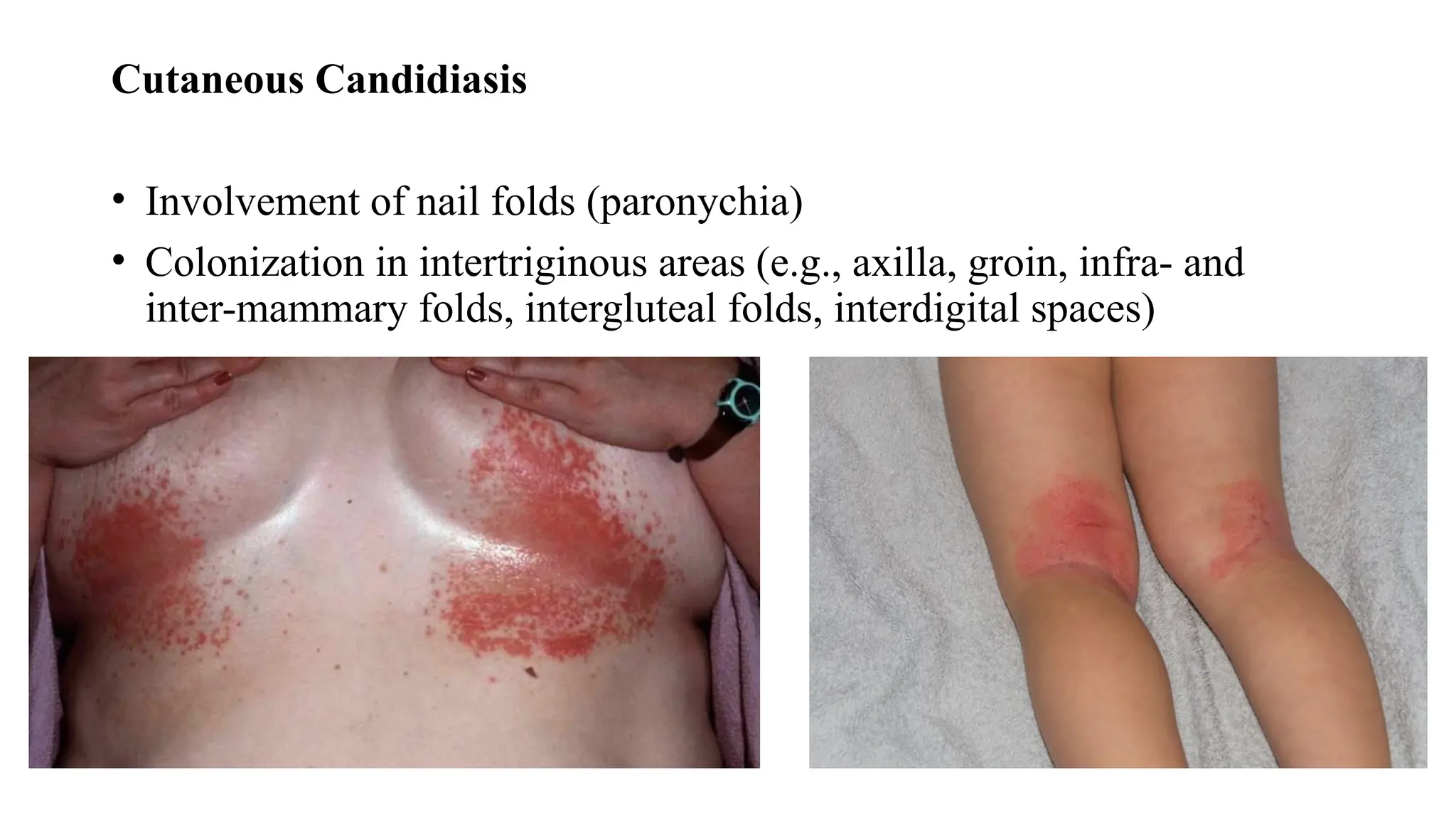 Candidiasis An Overview Dr Rajesh Patil Sir Pptx
