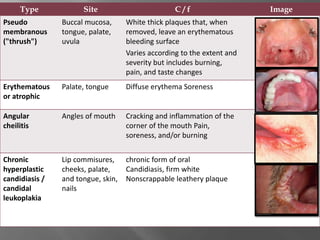 Candidiasis jc | PPTX