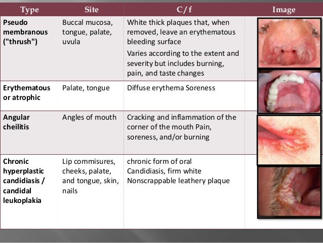 Candidiasis jc