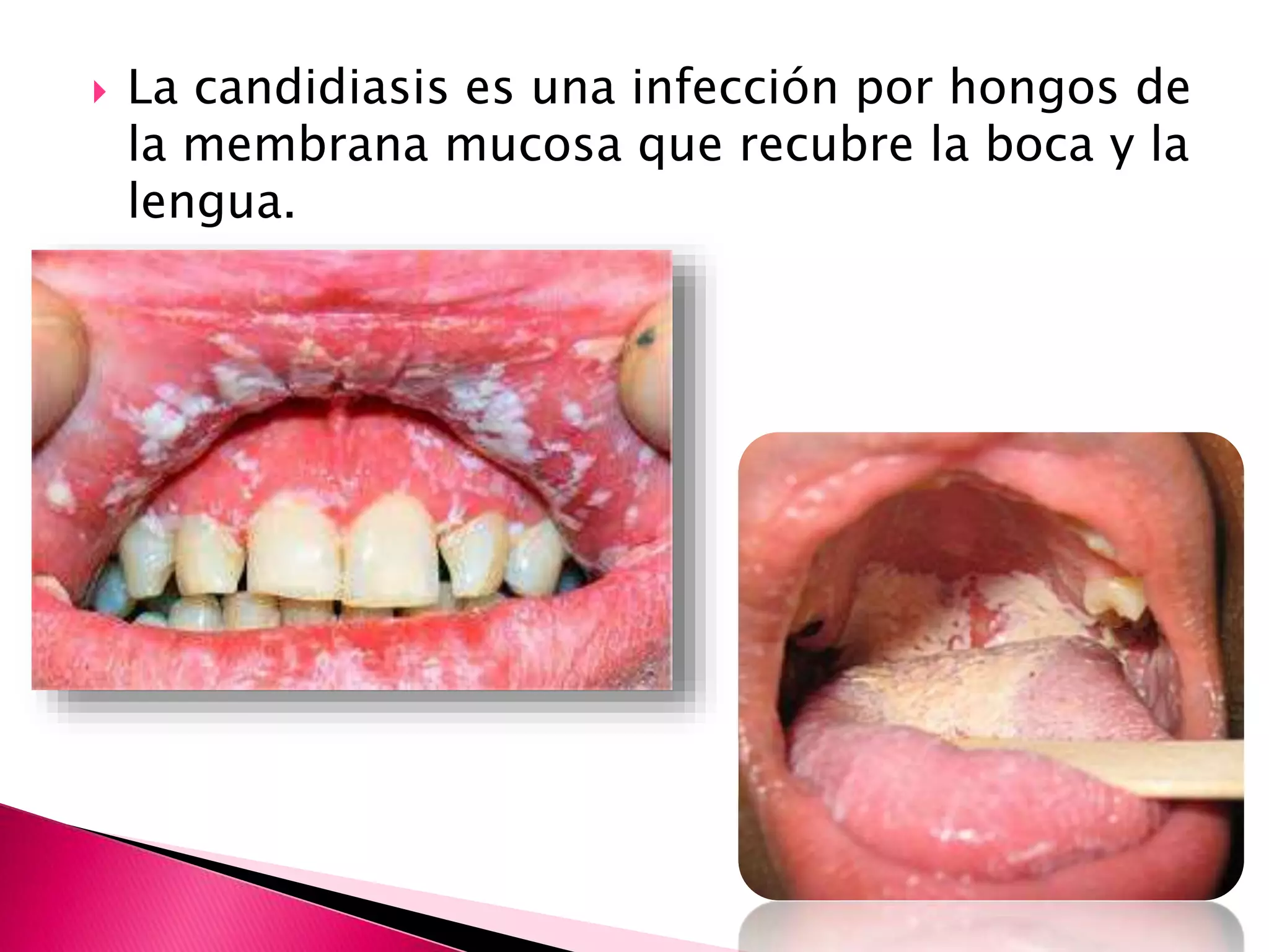 Candidiasis oral | PPTX