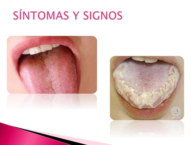 Candidiasis Oral: Síntomas, Causas Y Tratamiento – CKXK