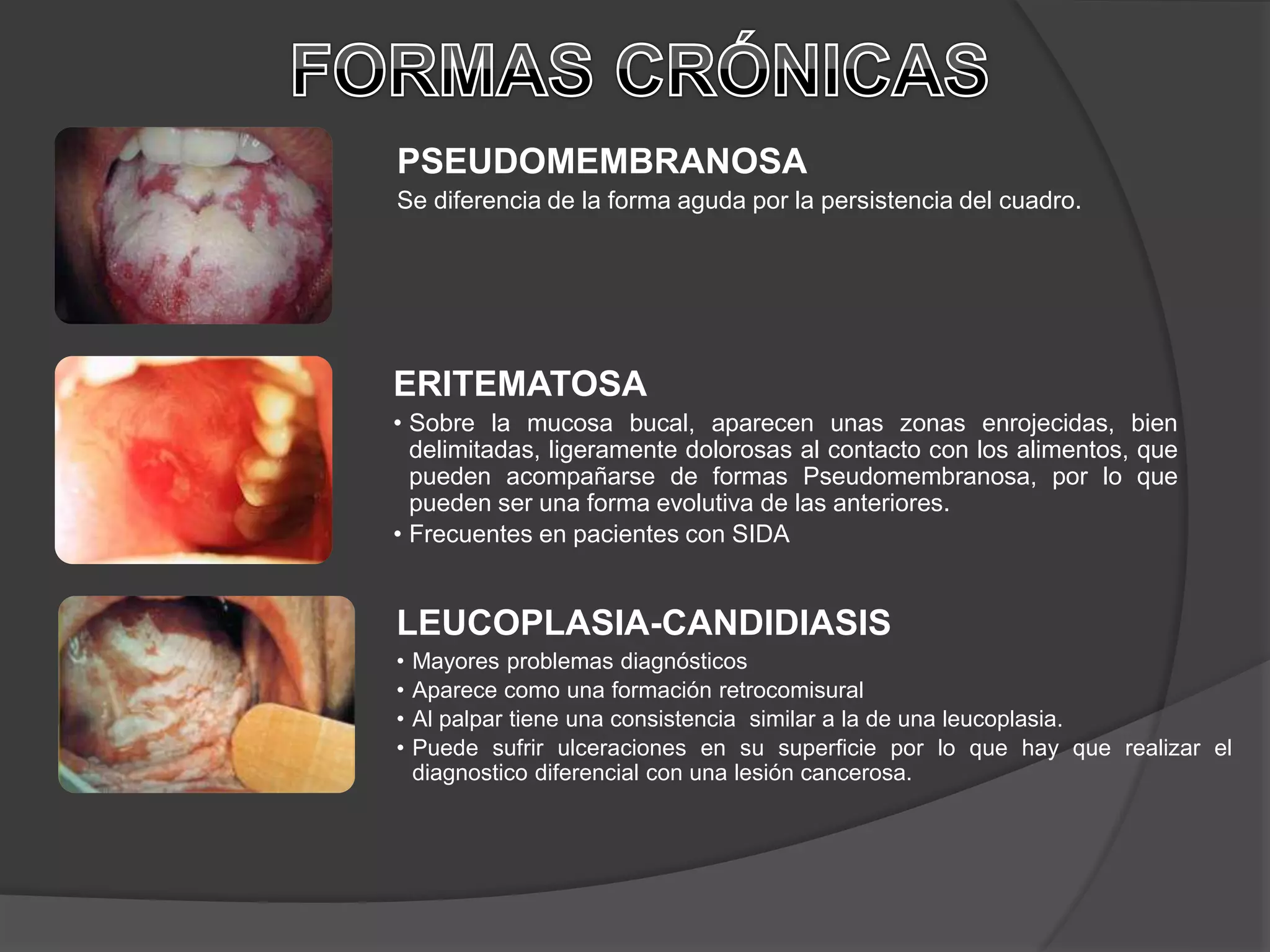 Candidiasis oral | PPTX