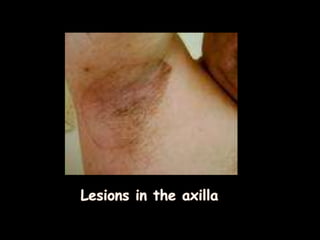 Cutaneous Candidiasis Armpit
