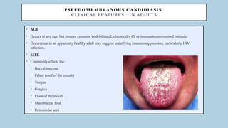 Oral Candidiasis: Clinical Features, Diagnosis and Management – By Dr ...