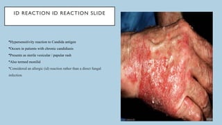 Oral Candidiasis: Clinical Features, Diagnosis and Management – By Dr ...