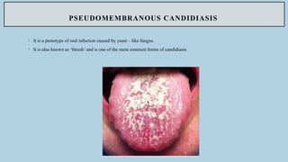 Oral Candidiasis: Clinical Features, Diagnosis and Management – By Dr ...