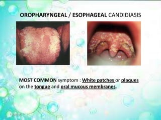 Candidiasis Presentation , SYMTOMPS, RISK FACTORS, MANAGEMEN | PDF
