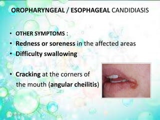 Candidiasis Presentation , SYMTOMPS, RISK FACTORS, MANAGEMEN | PDF