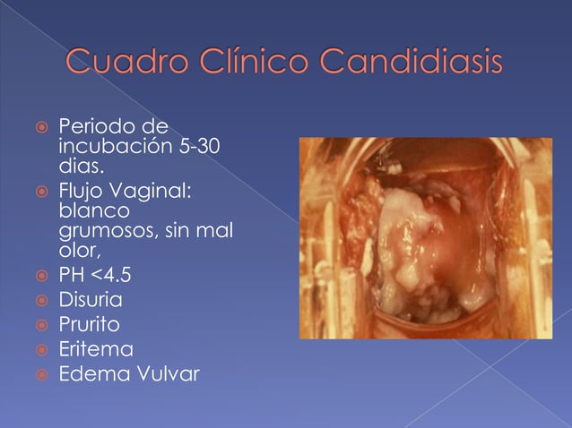 Candidiasis y trichomonas