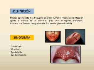 Candidosis | PPTX