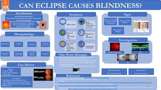 Can Eclipse causes Blindness in your Eyes? | PPTX