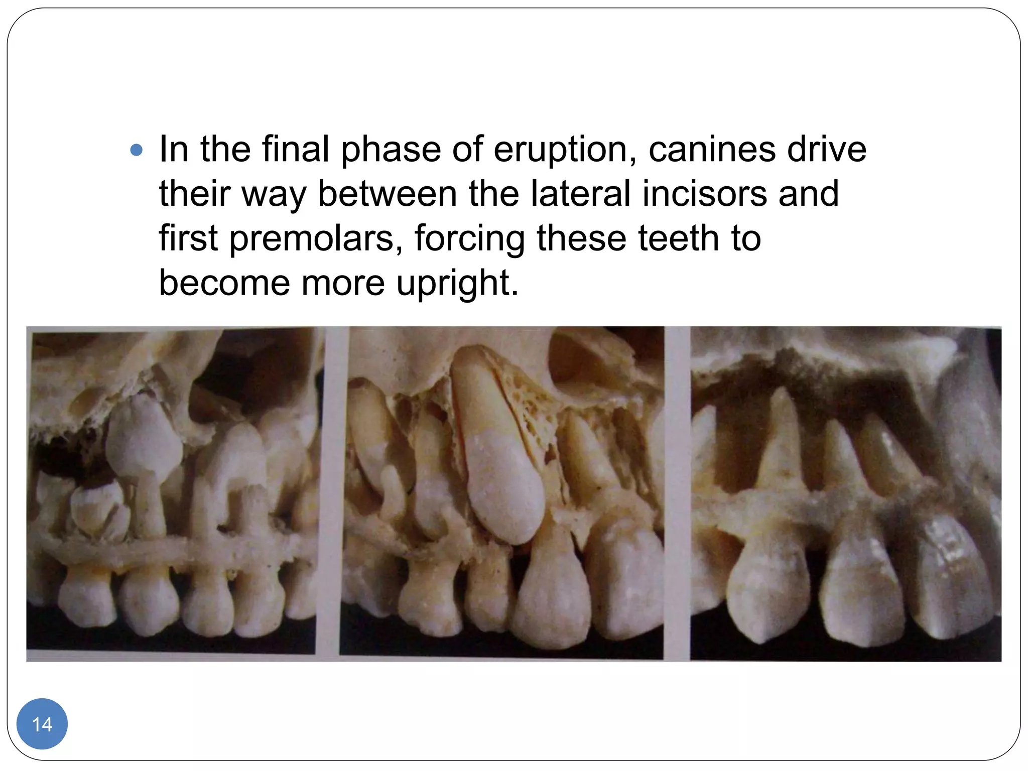 Canine Impaction and Its Importance in Orthodontics | PPTX
