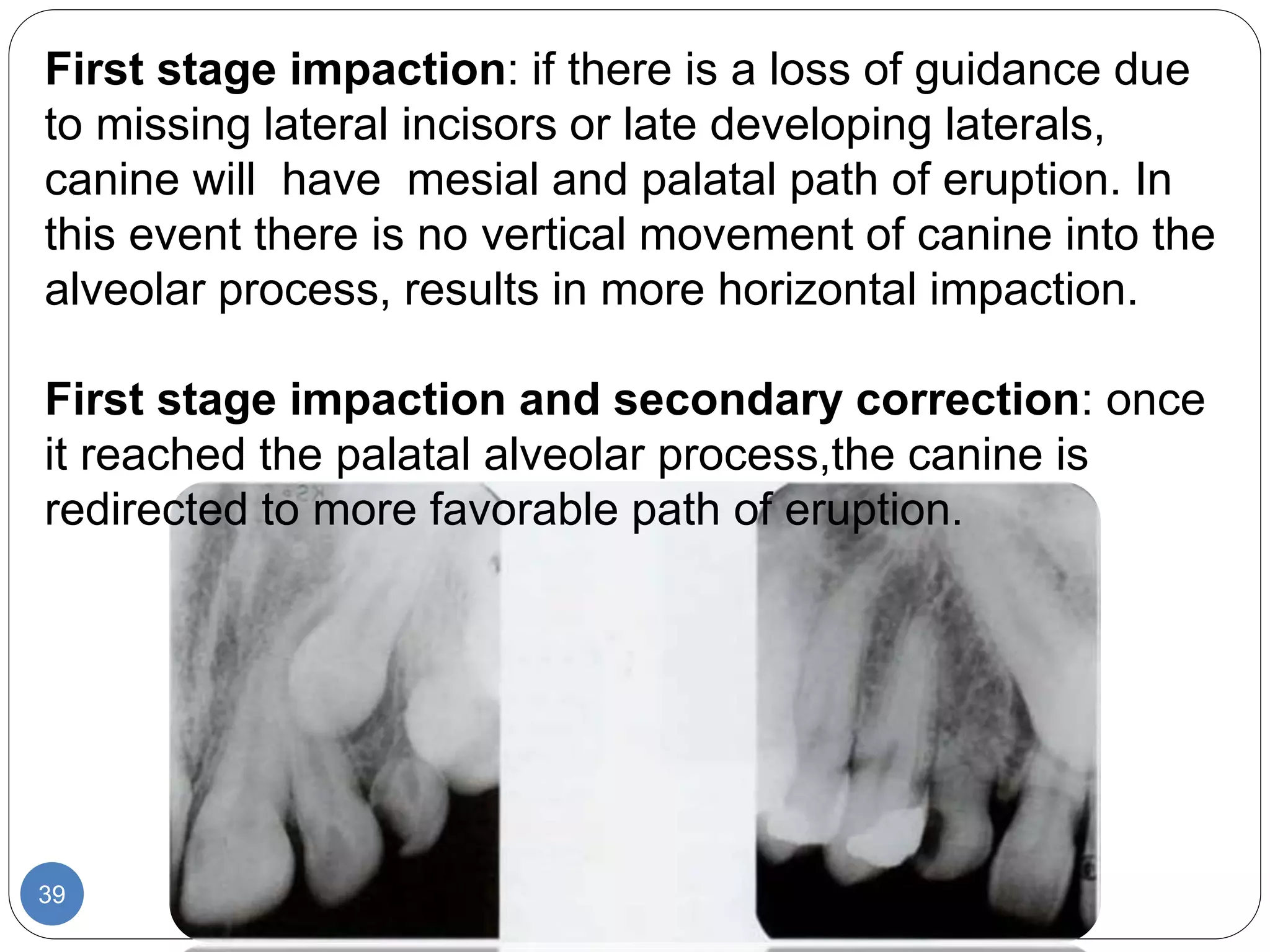 Canine Impaction and Its Importance in Orthodontics | PPTX