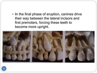Canine Impaction and Its Importance in Orthodontics | PPTX