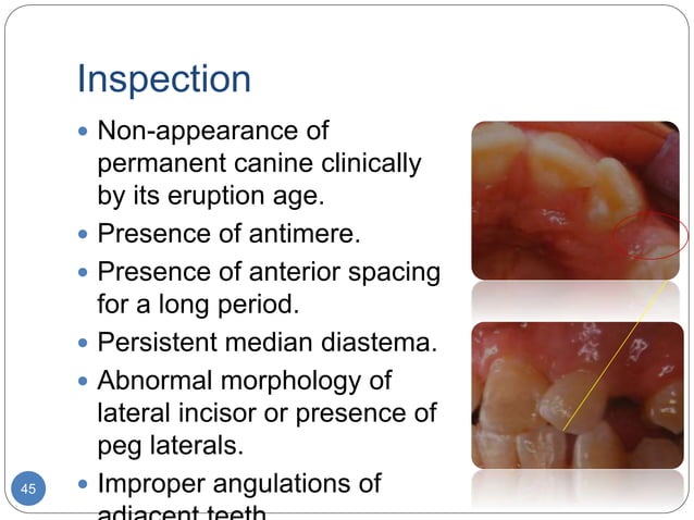 Canine Impaction and Its Importance in Orthodontics | PPTX | Dental ...