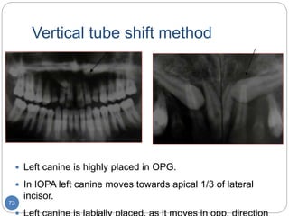 Canine Impaction and Its Importance in Orthodontics | PPTX