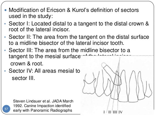 Canine Impaction and Its Importance in Orthodontics