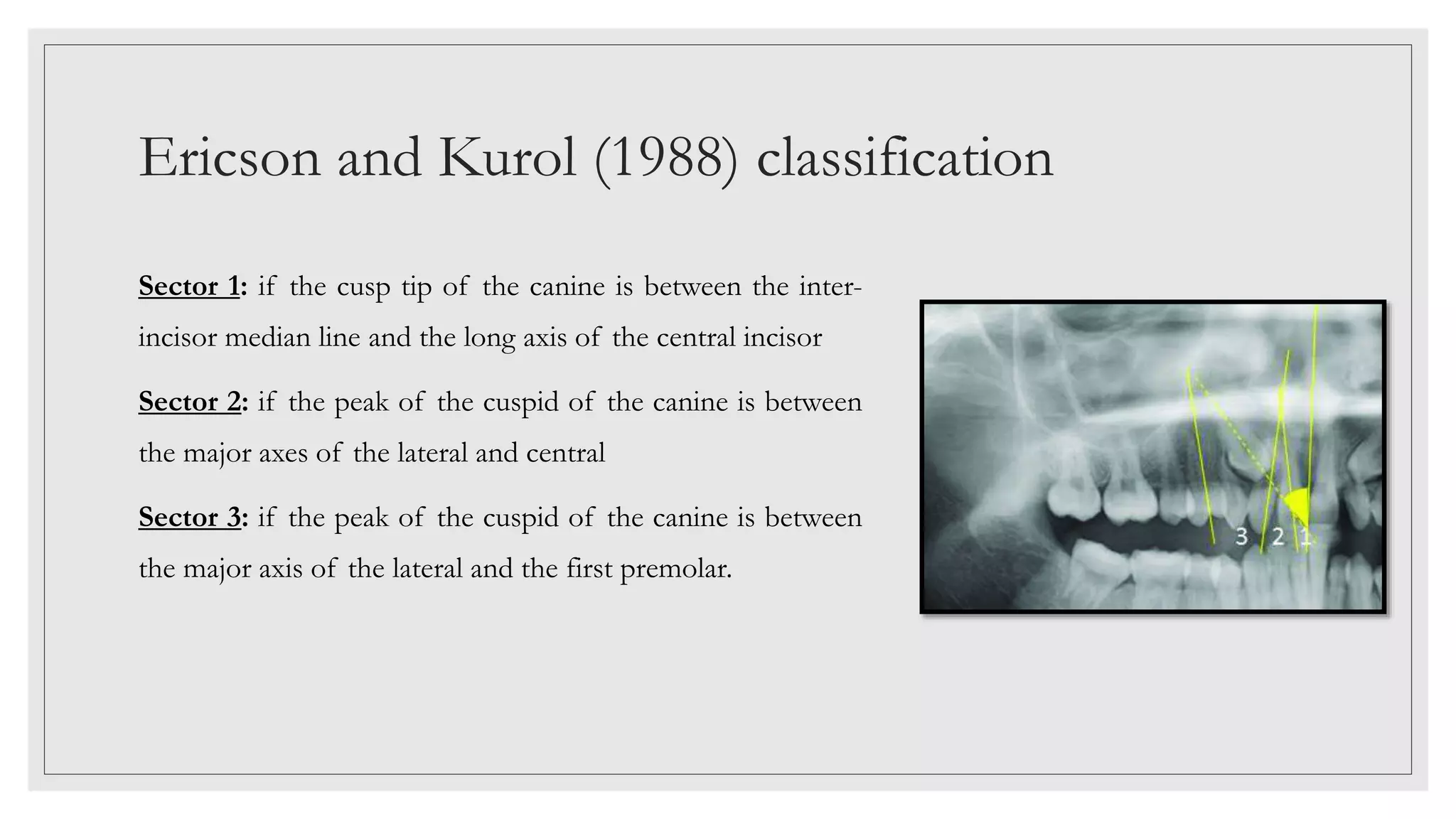 Canine impaction | PPTX