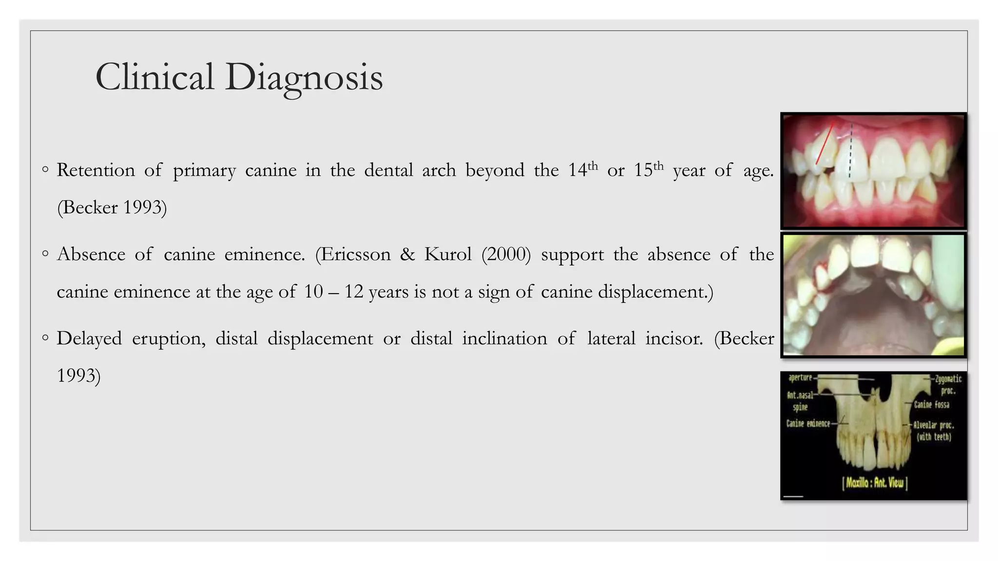 Canine impaction | PPTX