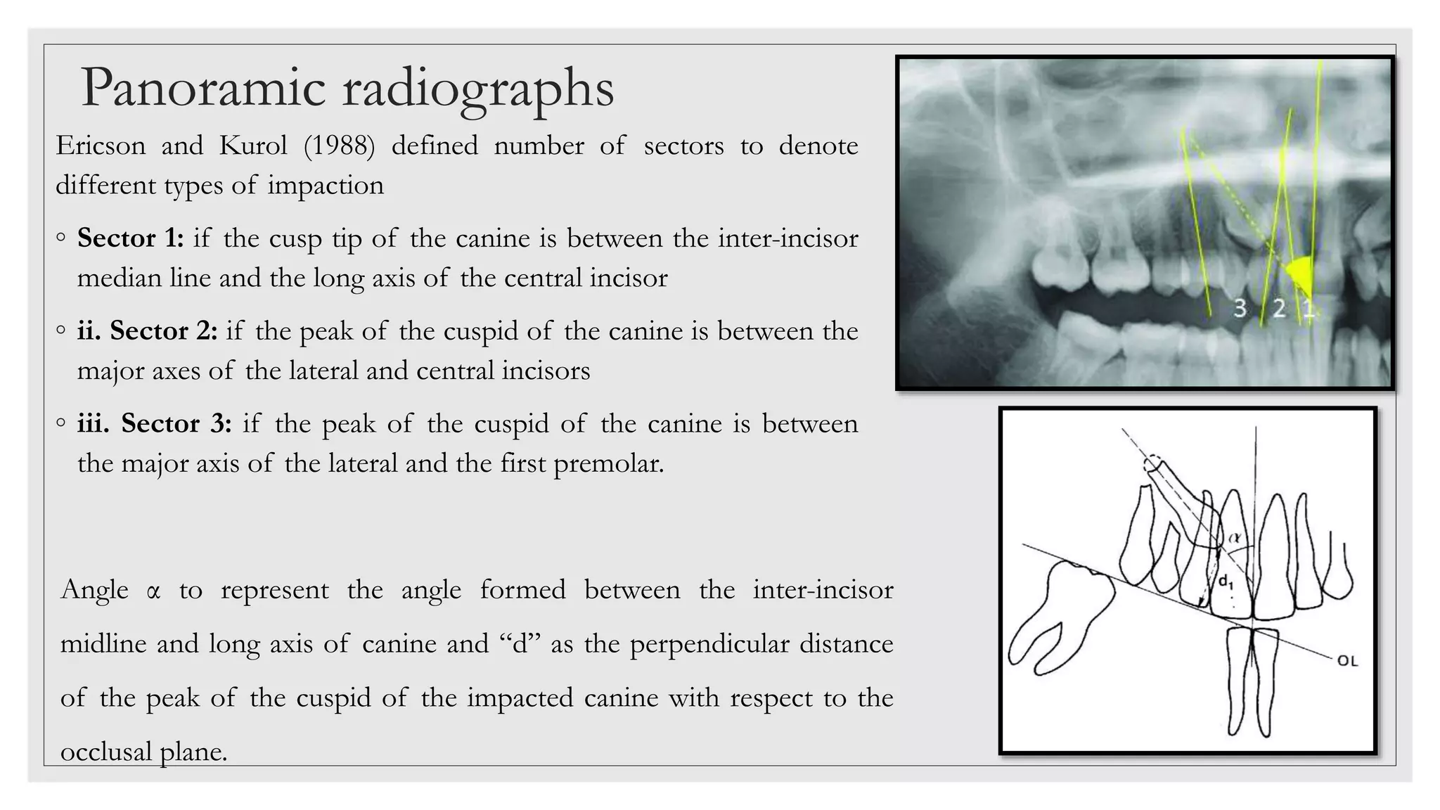 Canine impaction | PPTX