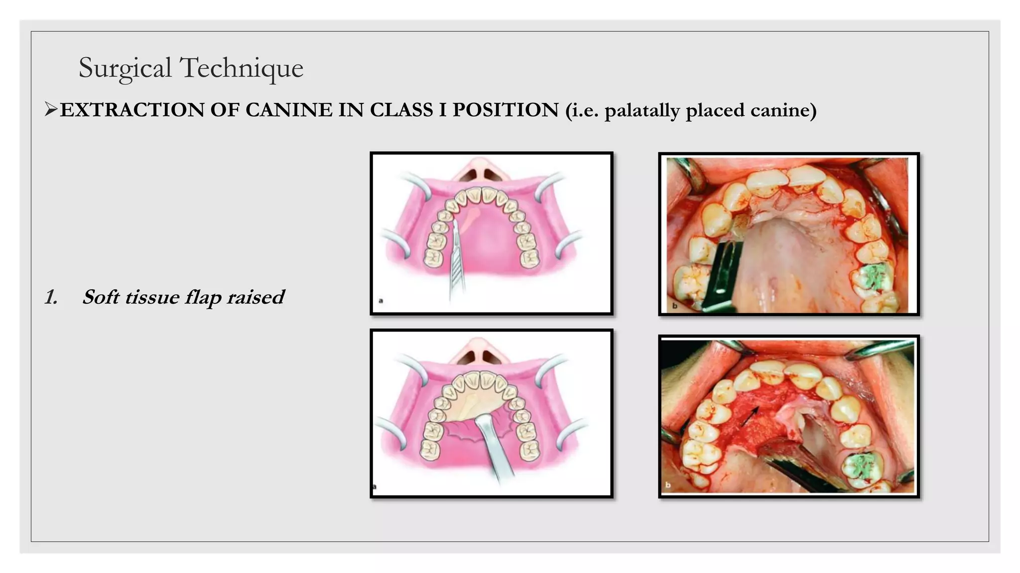 Canine impaction | PPTX