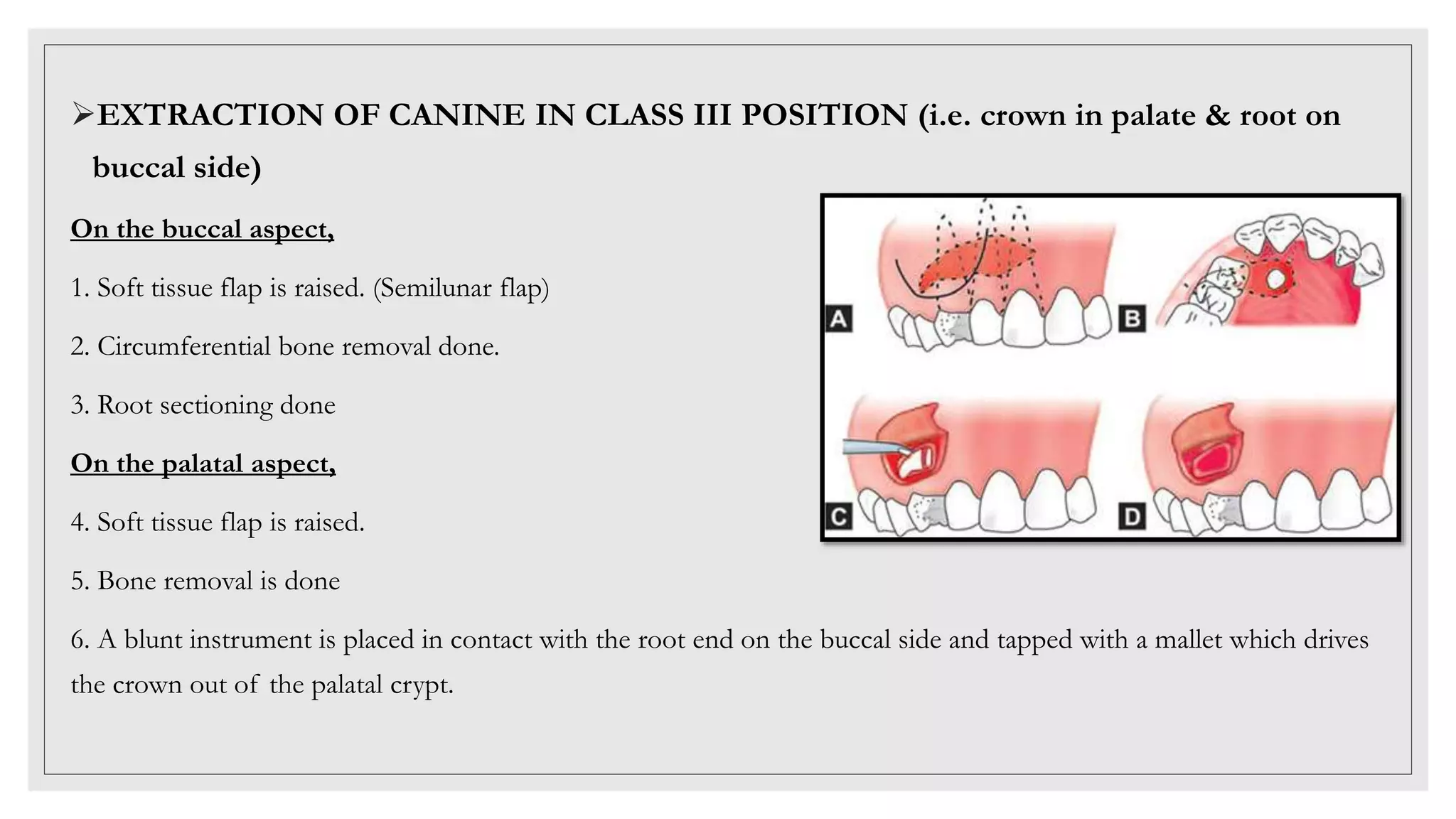Canine impaction | PPTX