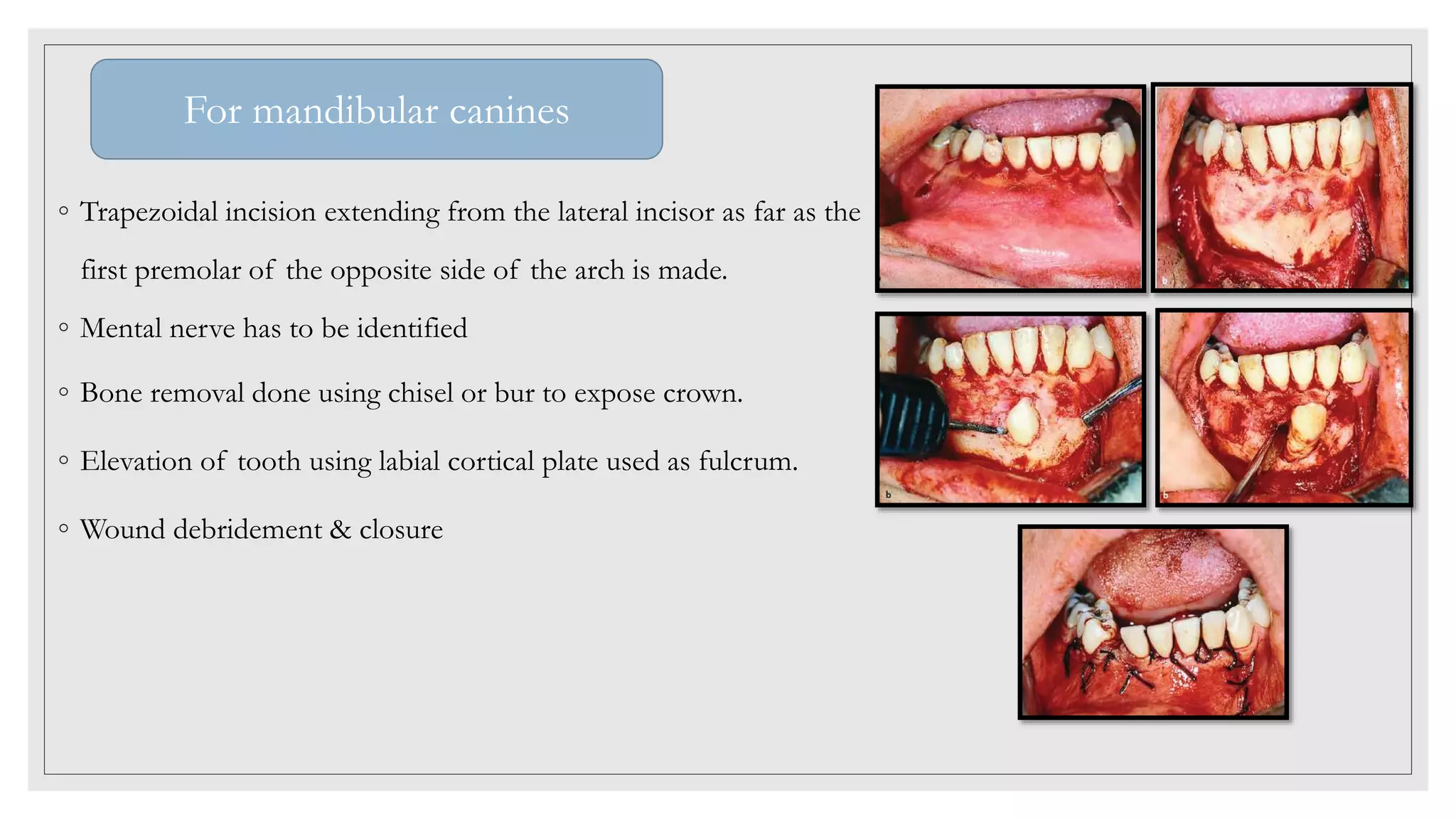 Canine impaction | PPTX